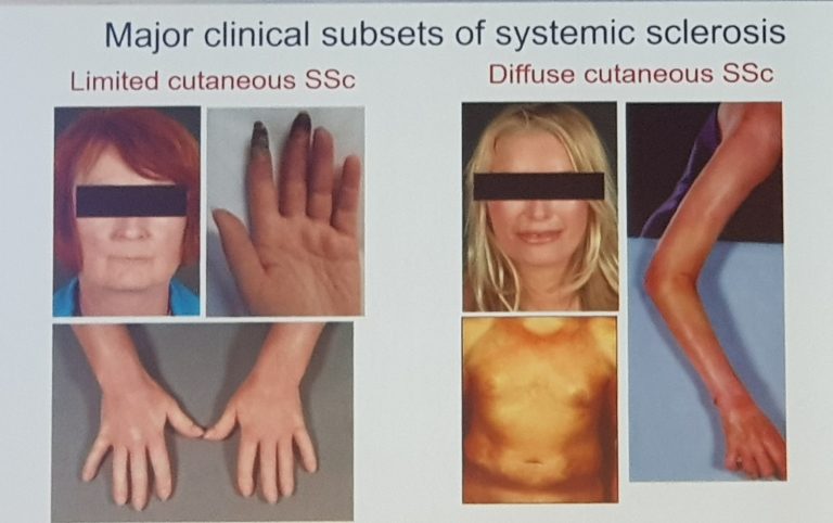 Skleroderma dan Lupus, Apakah Sama? | Dokter Rematik Autoimun