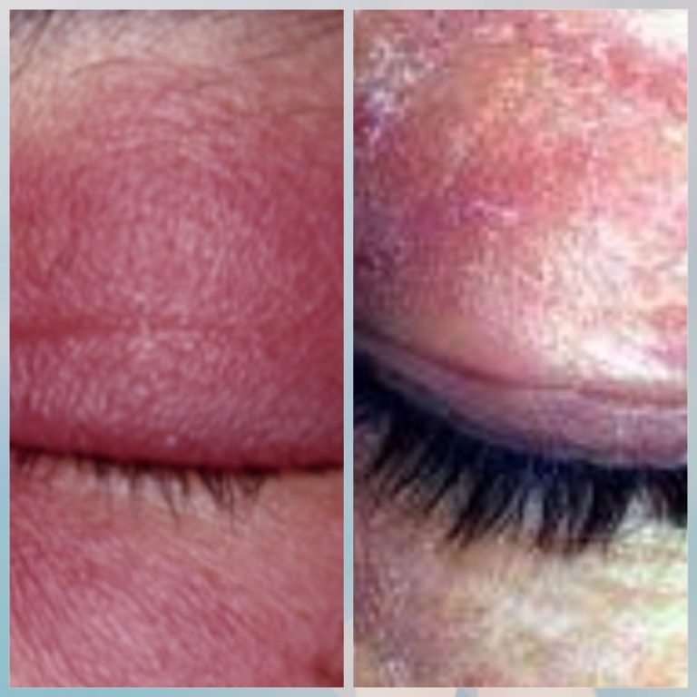 Lebih Mengenal Dermatomiositis | Dokter Rematik Autoimun